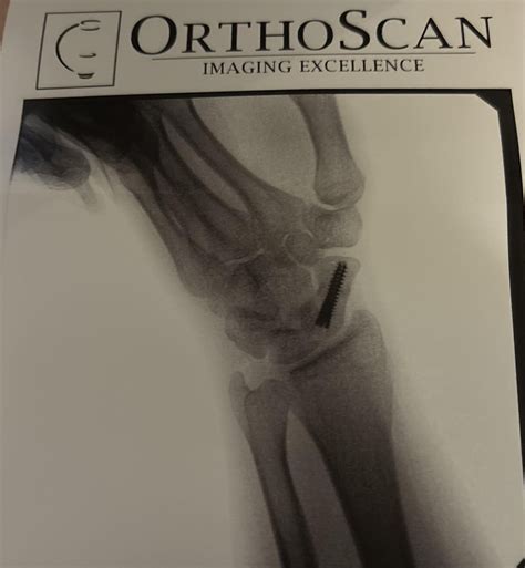 Got A Screw For My Scaphoid Fracture Today R Radiology