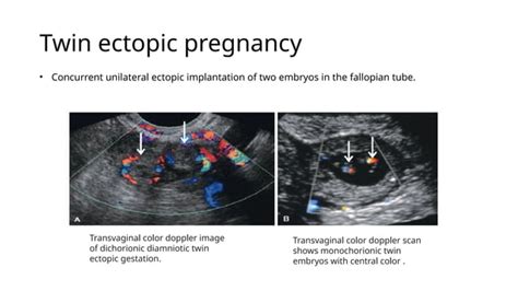 Ectopic Pregnancy 1pptcpowerpoint Presentation Ppt