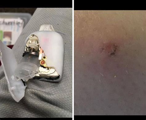 OmniPod News Next Generation Product Safety Concerns And An Exploding Pod