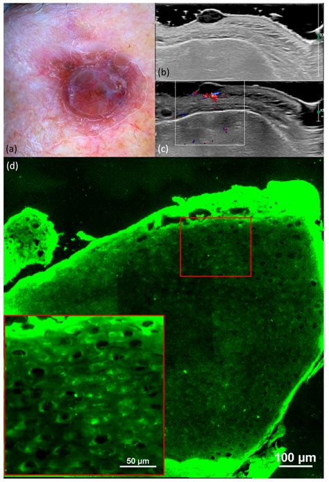 Nodular Adenoid Bcc Dermoscopy Shows Arborized Vessels Blue Grey