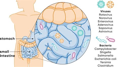Gastrointestinal Infection Stomach Flu Usz