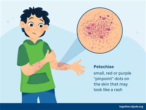 Thrombocytopenia Low Platelets Together By St Jude™