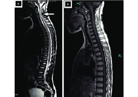 A B Mri Spine Sagittal View A T2 Weighted Image Showing Diffuse Download Scientific
