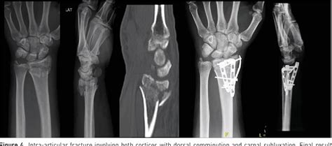 Figure 4 From Fragment Specific Fixation For Complex Intra Articular Fractures Of The Distal
