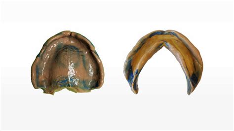 Edentulous Intraoral Scanning Issues