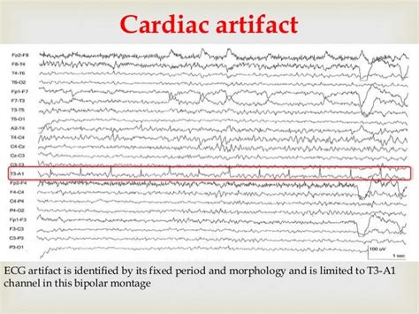 eeg artifact