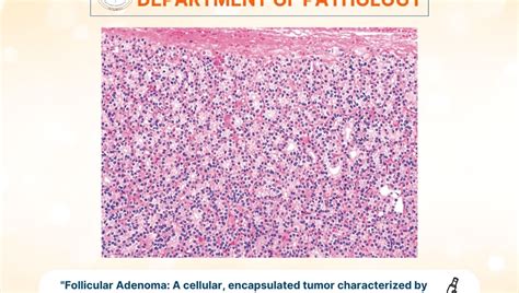 Adenoma Of The Thyroid