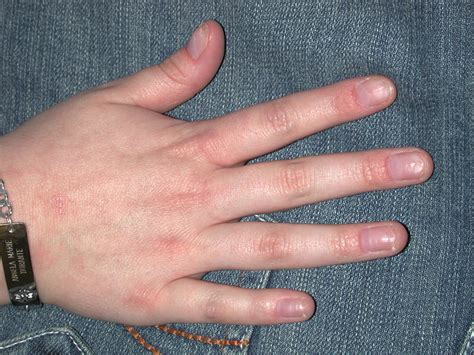 Ectodermal Dysplasia Hands