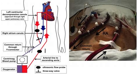 Velia Marta Antonini On Linkedin Extracorporeal Life Support With Left Ventricular