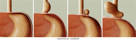 4 Hundred Hiatal Hernia Royalty Free Images Stock Photos Pictures Shutterstock