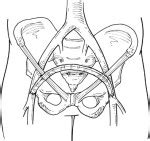 Axillofemoral Bypass Thoracic Key