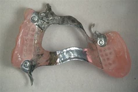 Removable Partial Denture Services L Partial Dentures Dublin