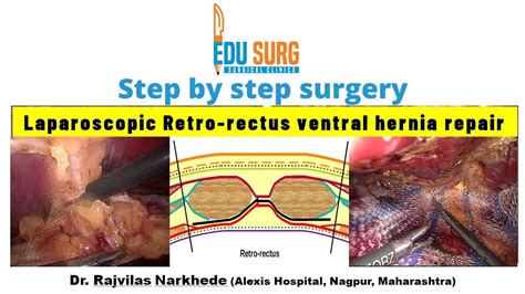 Laparoscopic Retrorectus Hernia Repair Ventral Hernia Surgery Umbilical Hernia Surgery Youtube