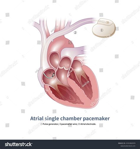Atrial Single Chamber Pacemakers Have Only Stock Illustration 2191962979 Shutterstock