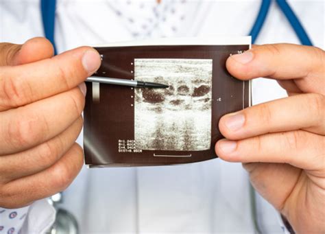 Difference Between Pyelectasis And Hydronephrosis 1 Difference Between Pyelectasis Vs