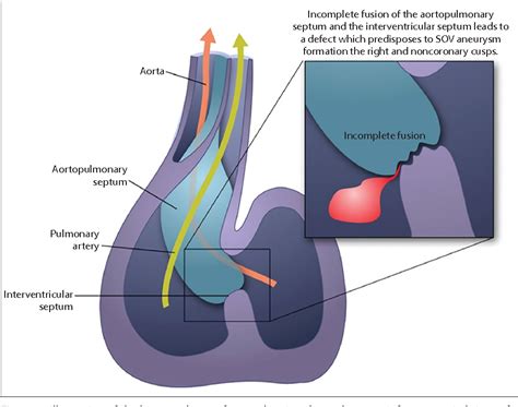 Figure 4 From Cross Sectional Imaging Of Sinus Of Valsalva Aneurysms