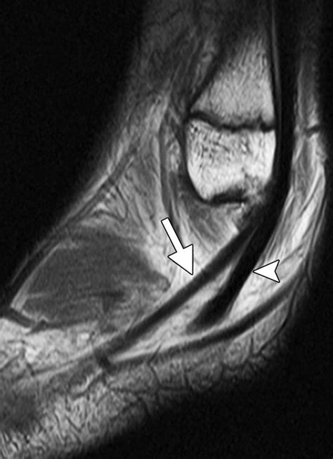 High Resolution Us And Mr Imaging Of Peroneal Tendon Injuriesradiographics