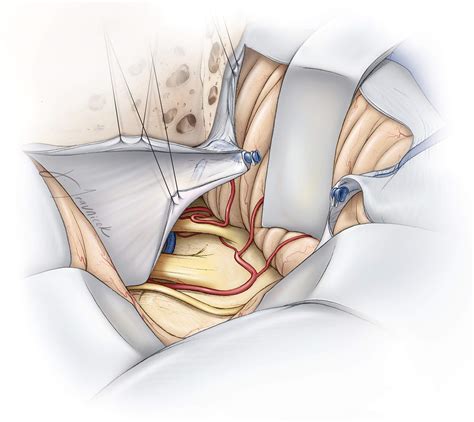 Posterior Petrosectomy The Neurosurgical Atlas