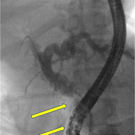 Endoscopic Retrograde Cholangiopancreatography Showing The Absence Of