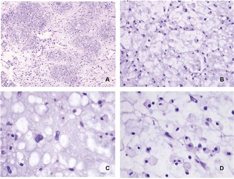 A The Myxoid Matrix Rich Region Displayed Lobulation Hand ×100 B