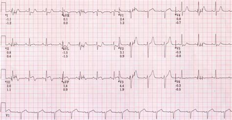 St Elevation During Treadmill Test