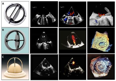 Echocardiography In Prosthetic Mitral Valve Evaluation