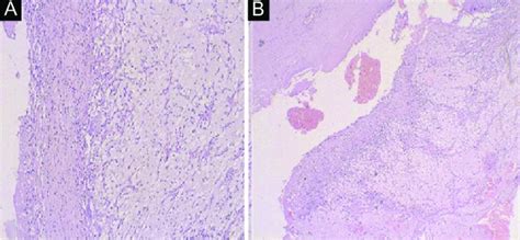 A B Consistent Findings With Low Grade Appendiceal Mucinous Neoplasm Download Scientific