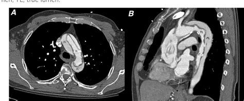 Figure 4 From The Role Of Multidetector Row Ct In The Diagnosis
