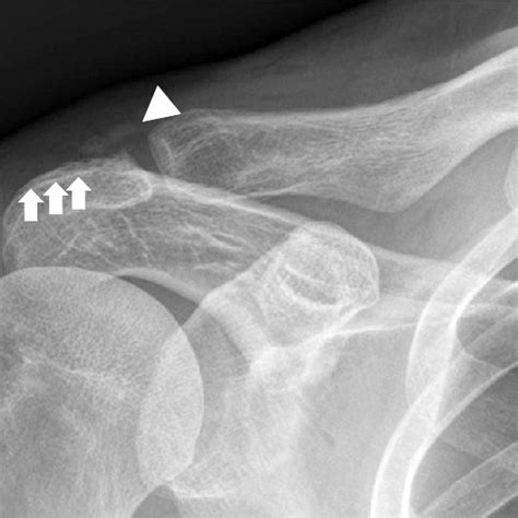 Pdf Ultrasonographic Diagnosis Of Non Displaced Avulsion Fracture Of The Acromion A Case Report