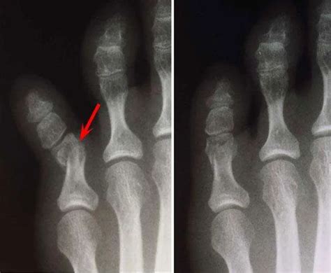 Distal Phalanx Fracture Toe Orthobullets