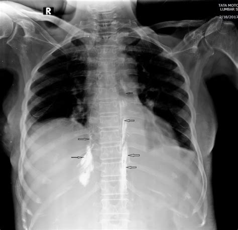 X Ray After Contrast Injection Through Catheters Arrows Showing Linear Download Scientific