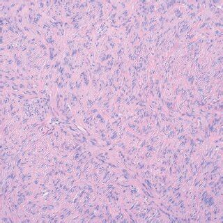 Spindle Cell GIST With Strong Immunostaining For CD34 Magnification 400 Download