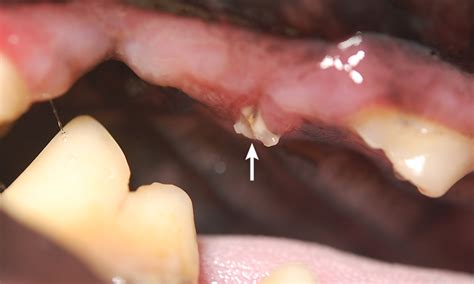 Tooth Fracture Clinicians Brief