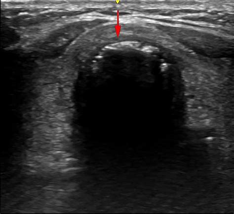 The Inter Annular Space Between The Second And Third Tracheal Ring The