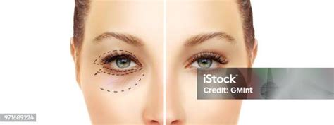 Blepharoplastyupper 안 검 성형 낮은 내 시경이 마와이 마 리프트입니다 얼굴을 표시 여성 얼굴 성형 수술 개념에 구멍 뚫 기 라인 눈꺼풀에 대한 스톡 사진