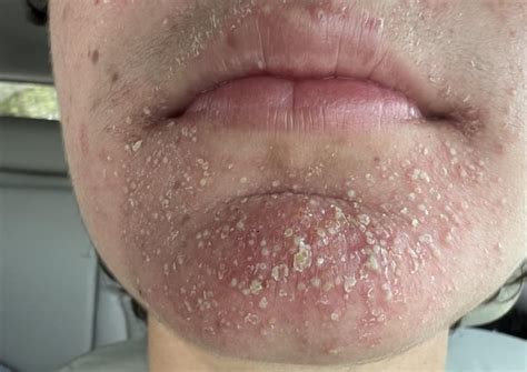 [routine Help] White Pustules On Chin R Skincareaddiction