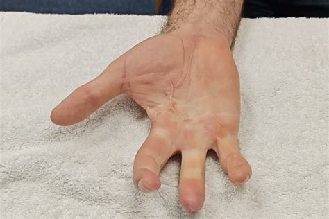 Scar Therapy Belfast The Hand Therapist