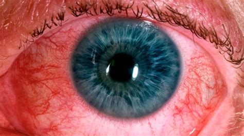 Uveitis Und Multiple Sklerose Interdisziplinär Behandeln