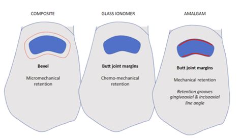 Class V Composite And Glass Ionomer Restorations Flashcards Quizlet