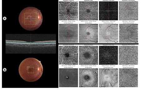 OCT A Of Right Eye A Imaging On Presentation OCT A In All Layers With Download Scientific