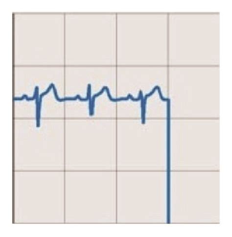 Ecg Signal Processing A First Stage Of Amplification B Impedance Download Scientific