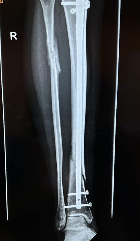 Broke My Tibia And Fibula On Jan 26th My Doctor Told Me Hes Never Seen