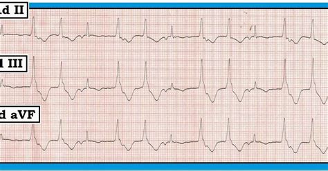 ECG Interpretation ECG Blog Ventricular Echo