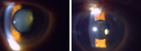 Cataract Dr Orwa Nasser