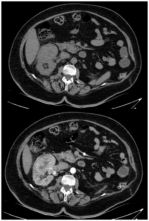 Metachronous Rapidly Growing Papillary Type 2 Renal Cell Carcinoma Following Contralateral Clear