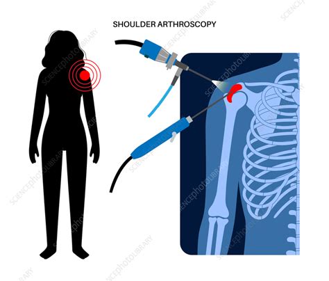 Shoulder Arthroscopy Procedure Illustration Stock Image F042 8265 Science Photo Library