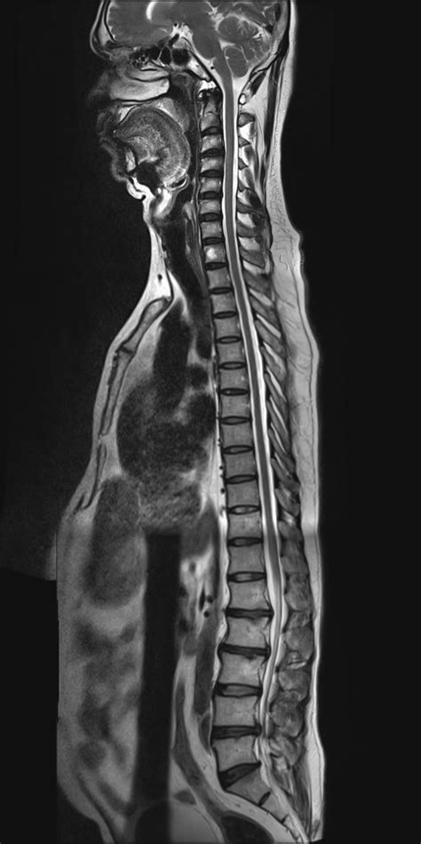 Ultimate Radiology Straight Back Syndrome