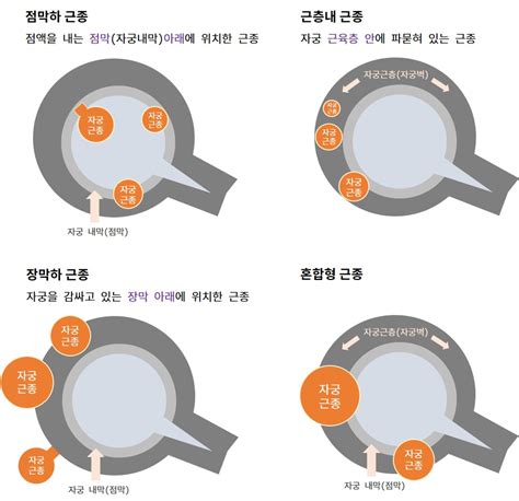 자궁에 문제가 있는 상황이라면