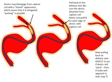 Pipeline Embolization Of Cerebral Aneurysms