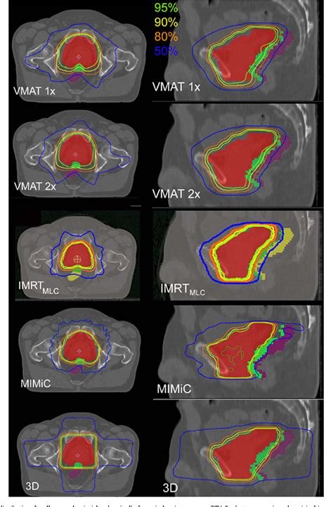 Volumetric Modulated Arc Therapy Vmat Vs Serial Tomotherapy Step And Shoot Imrt And 3d